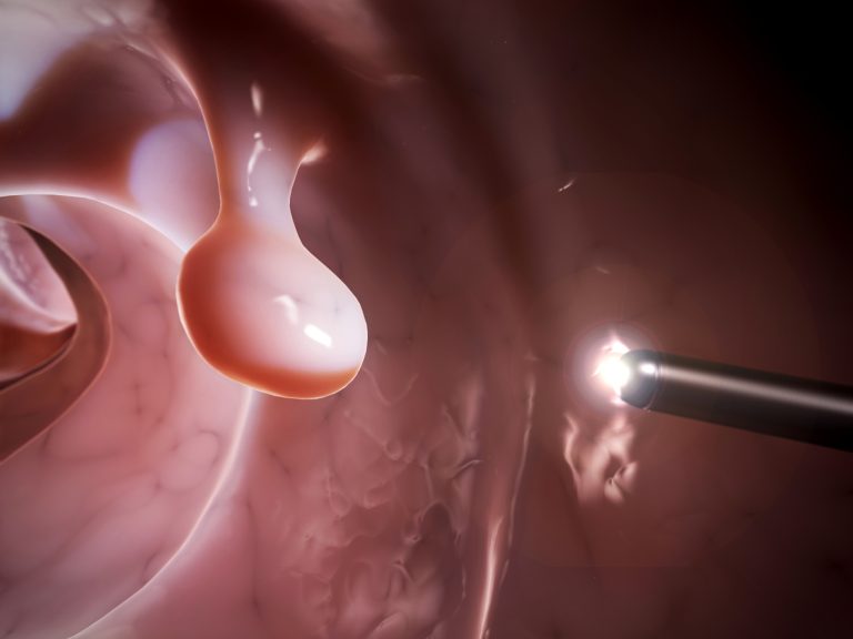 Are colon polyps the same as colon cancer? – Welia Health